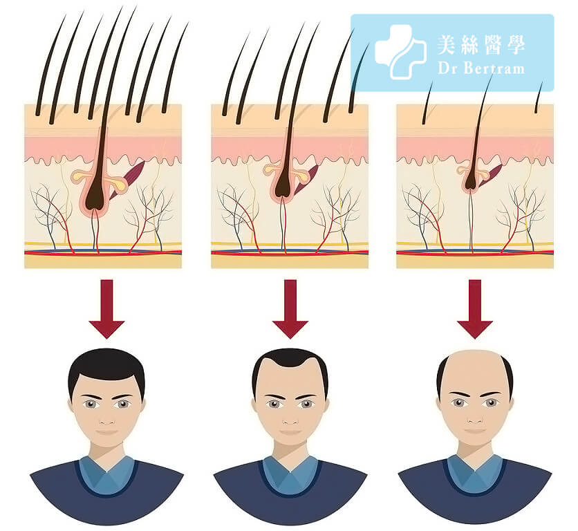 Androgenetic Alopecia (AGA): Causes, Diagnosis & Transplant Candidacy ...